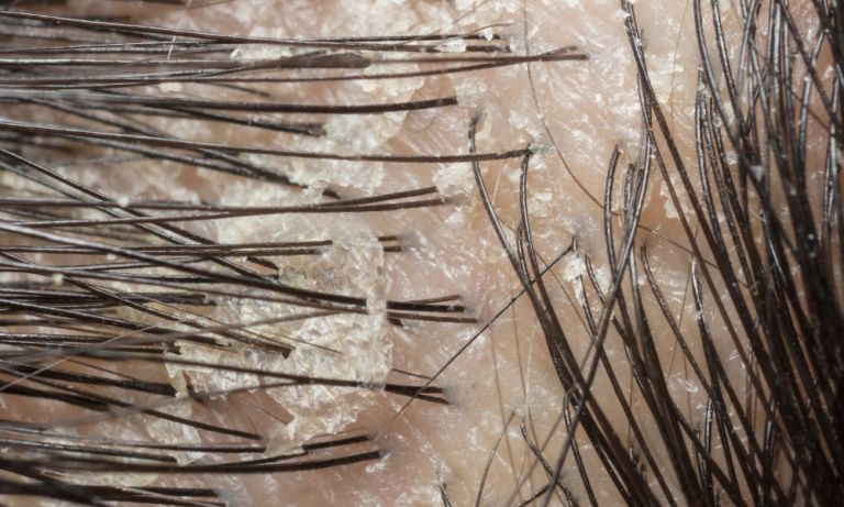 Seborrheic Dermatitis Causes & Treatments HairBack Clinic