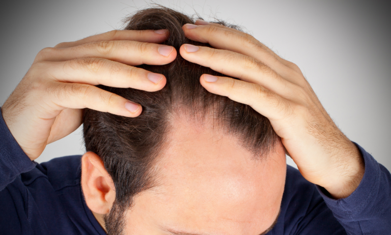 Testosterone And Hair Loss – Is It Related? HairBack Clinic